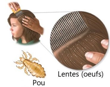 Comment se débarrasser des poux naturellement. Retrouvez